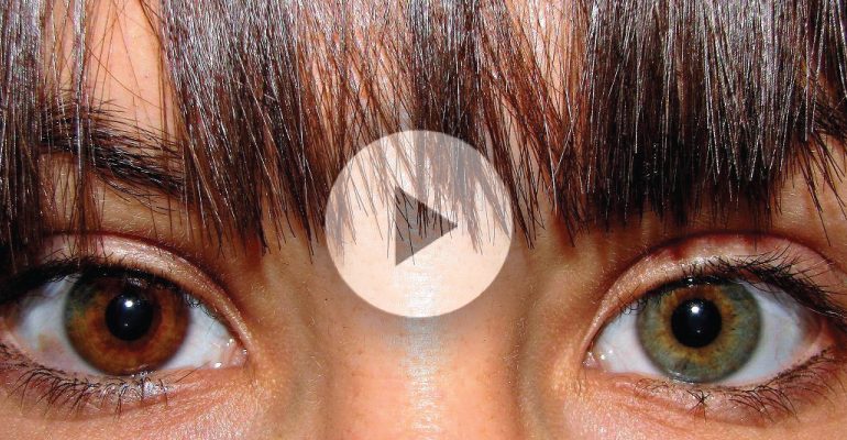 How does someone get two different-colored eyes? | Morgridge Institute ...