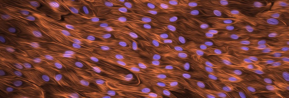 New stem cell method sheds light on a tell-tale sign of heart disease ...